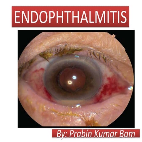 ENDOPHTHALMITIS.PRABIN.pptx | Eye and Vision Conditions | Diseases and ...