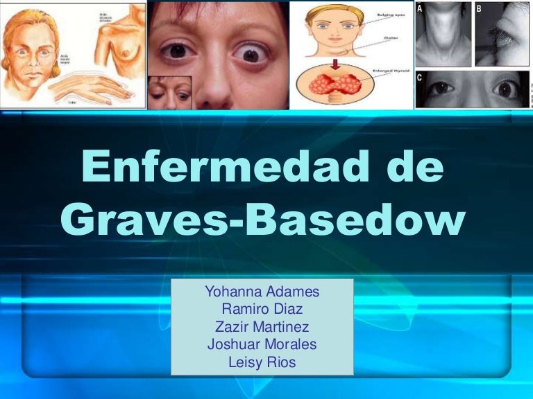 abajo cera Asado graves basedow ojos Tres Pericia Implacable