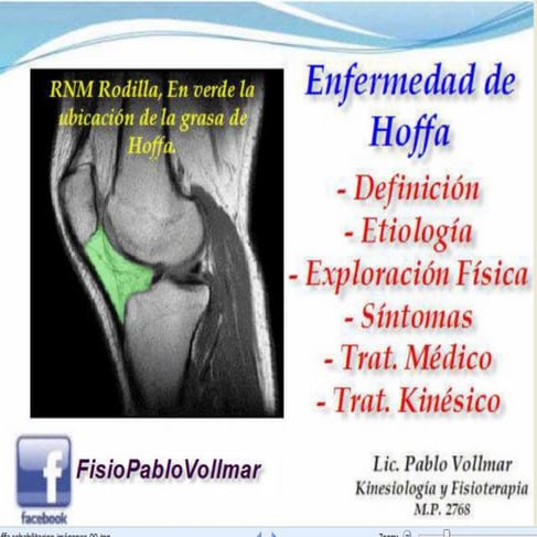 enfermedad de hoffa fisio pablo vollmar.PDF