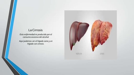 Enfermedades del alcohol | ODP | Heart and Cardiovascular Diseases ...