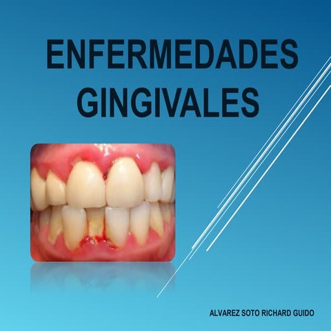 Enfermedades gingivales | PPT