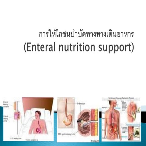 การให้ Enteral nutrition | PDF
