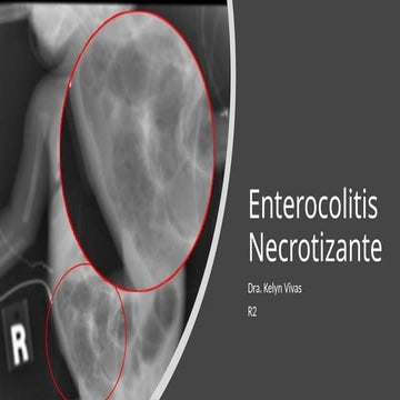 enterocolitis necrotizante en pediatria.pptx