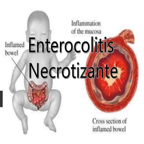 enterocolitisnecrotizante-230716135700-f866eee3.pdf