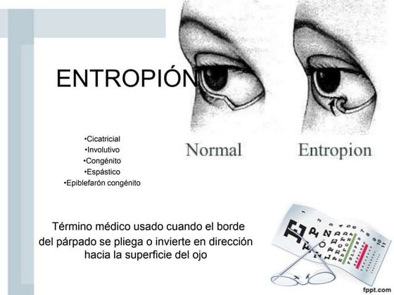 Entropion | PPTX | Eye and Vision Conditions | Diseases and Conditions