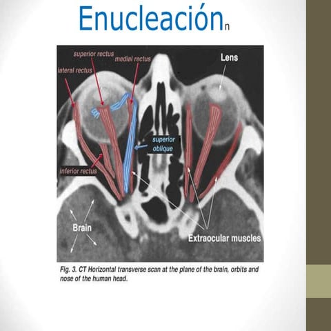 ENUCLEACION FINAL 1.ppt