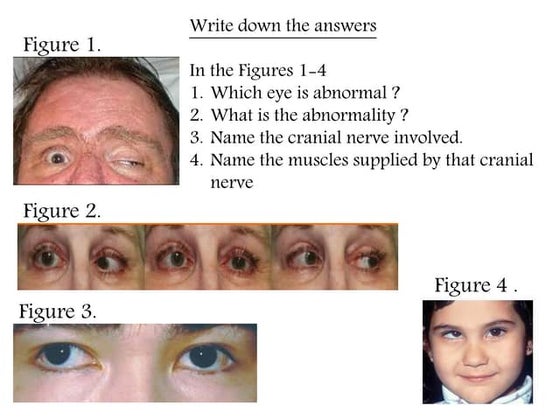Forced duction test | PPTX | Eye and Vision Conditions | Diseases and ...