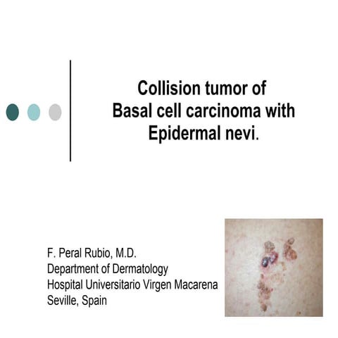 Epidermal nevi and basal cell carcinoma | PPT