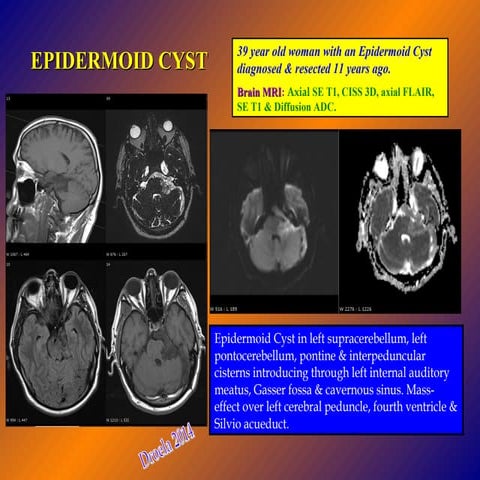 Epidermoid cyst | PPT