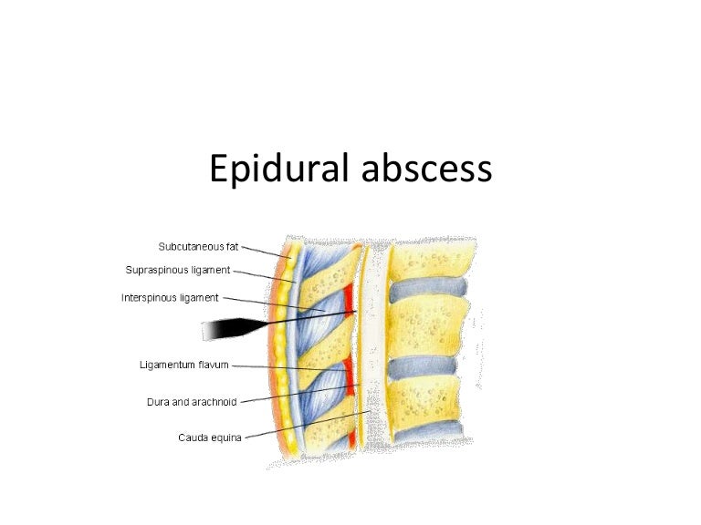 Epidural abscess