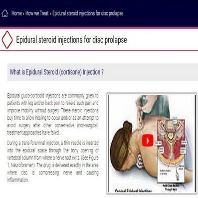 Epidural steroid injections for disc prolapse | PPT