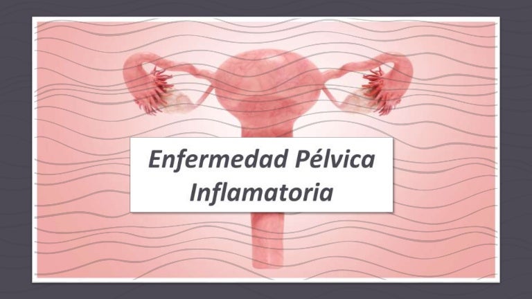 Enfermedad Pélvica Inflamatoria (EPI)