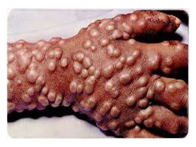 small pox communicable disease.pptx