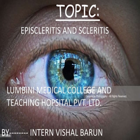 Episcleritis and scleritis (ophthalmology) | PPTX