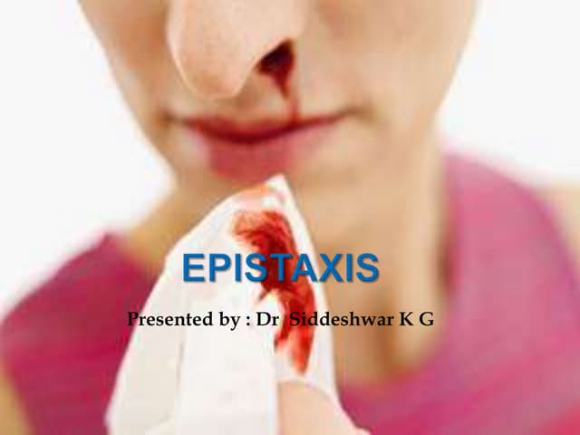Epistaxis | PPT