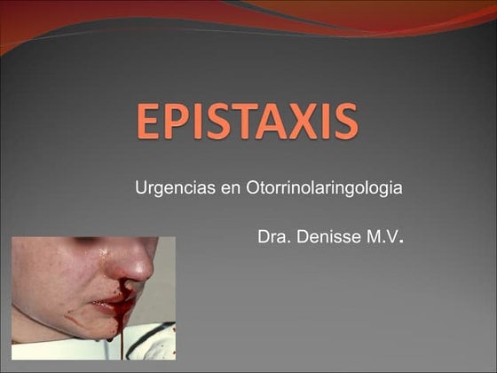 Epistaxis | PPT