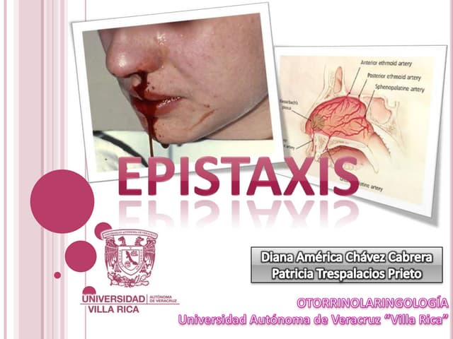 Epistaxis | PPT