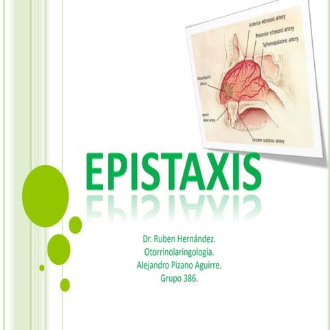 Epistaxis | PPT