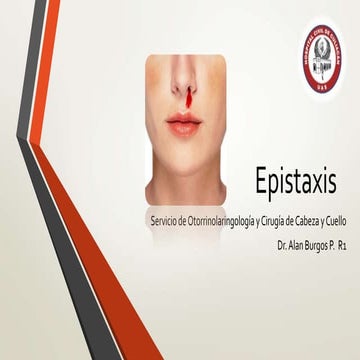 Epistaxis | PPTX