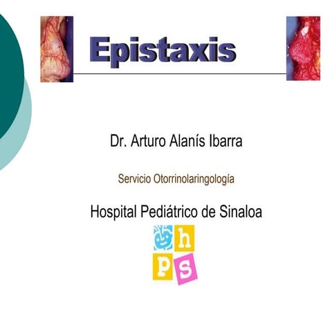 Epistaxis | PPT