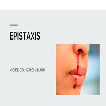 Epistaxis | PPT
