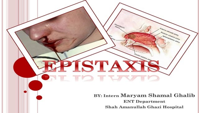 Epistaxis | PPT