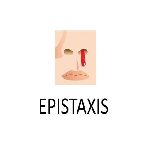EPISTAXIS.pptx