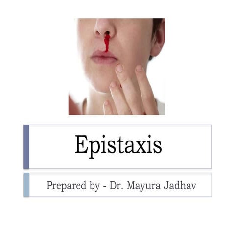 Epistaxis.pptx bleeding through nose know the treatment | PPT