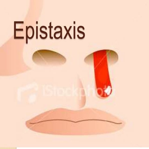 Epistaxis ent | PPTX
