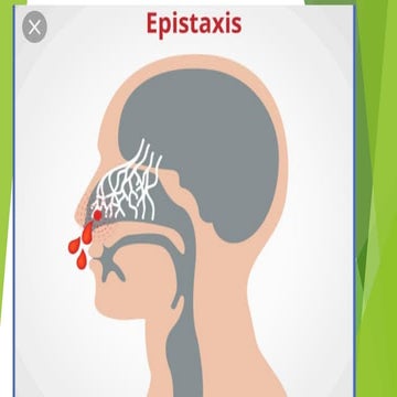 EPISTAXIS final.pdf
