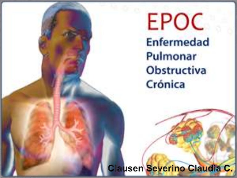 Epoc