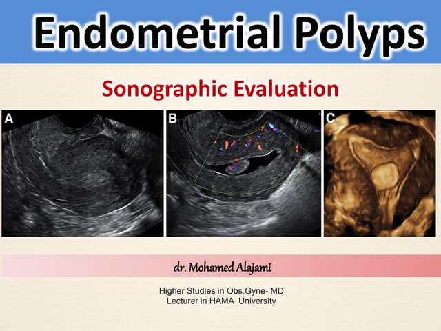 Endometrial polyp | PPTX | Reproductive Health | Diseases and Conditions