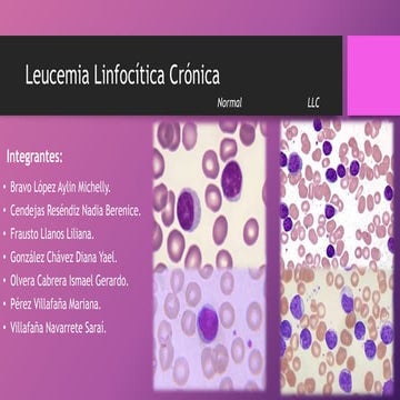 Equipo #6 chronic lymphocytic leukemia (cll) (1) | PPTX