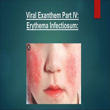 Erythema Infectiosum Lacy Rash