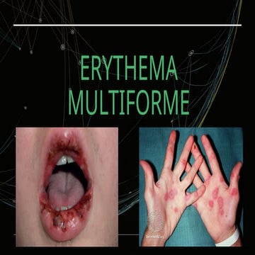 ERYTHEMA MULTIFORME.pptx by department of oral medicine | PPTX