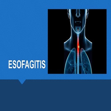 Esofagitis | PPT