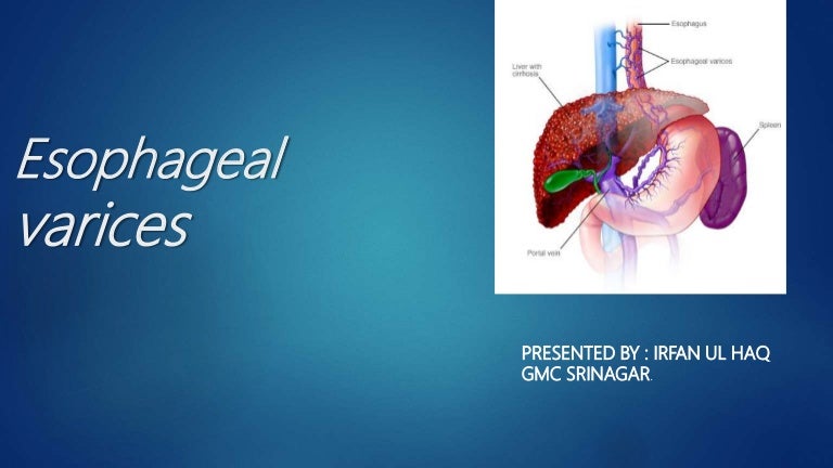 Esophageal Varices