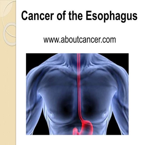 Esophagus cancer | PPTX