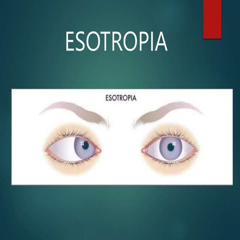 Esotropia ophthalmology presentation HSAH.pptx
