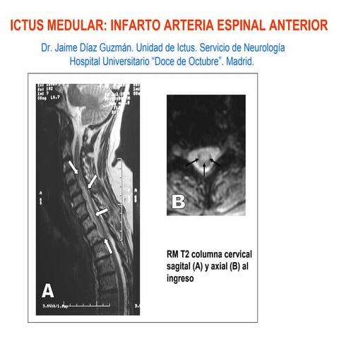 Patología vascular medular. | PPTX