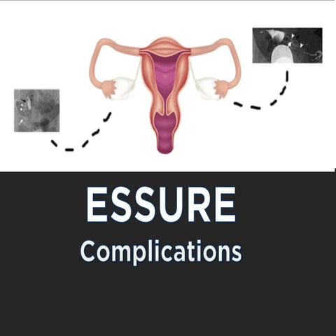 Essure Insert Complications: See The Data Prompting Lawsuit ...