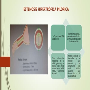 ESTENOSIS HIPERTROFICA DEL PILORO Y ECOGRAFIA.pptx
