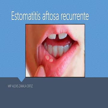 Estomatitis aftosa recurrente | PPTX