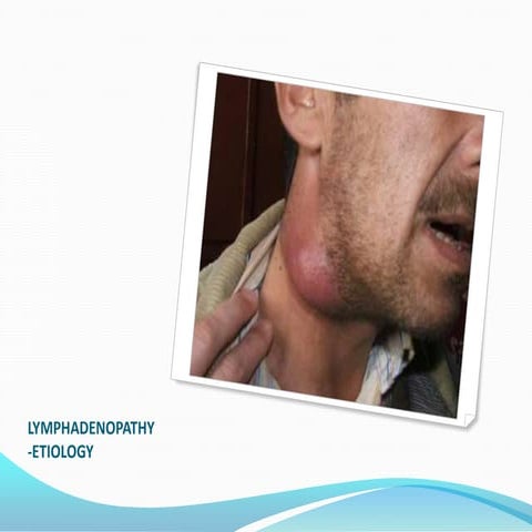 Etiology of lymphadenopathy | PPTX