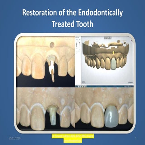 restoration of endodontically treated teeth cast post | PPTX