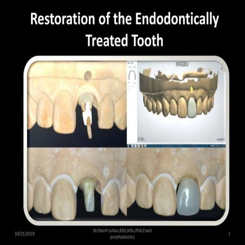 restoration of endodontically treated teeth ready post | PPT