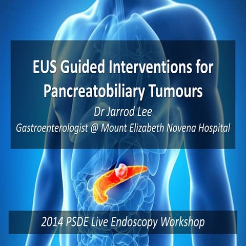EUS Guided Interventions for Pancreatobiliary Tumours | PDF