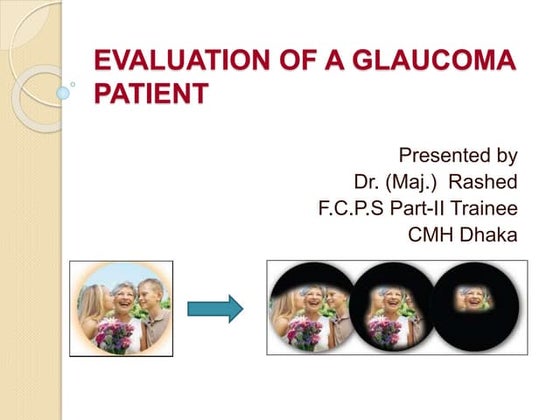 pseudoexfoliative glaucoma | PPT