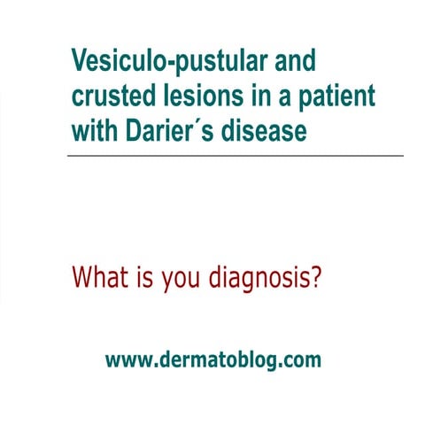 Vesiculo-pustular and crusted lesions in a patient with Darier´s ...