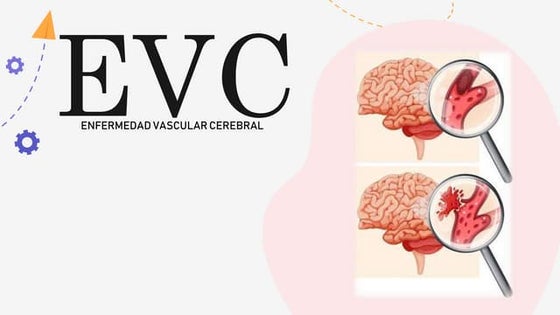 accidente cerebrovascular isquemico - presentacion | PPT